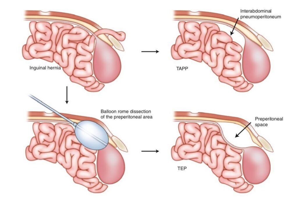 Hernia Treatment Options - Dr. Aditya K. Sharma